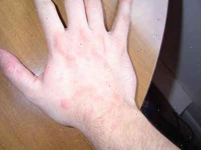 Hoe te behandelen netelroos natuurlijk – E2H